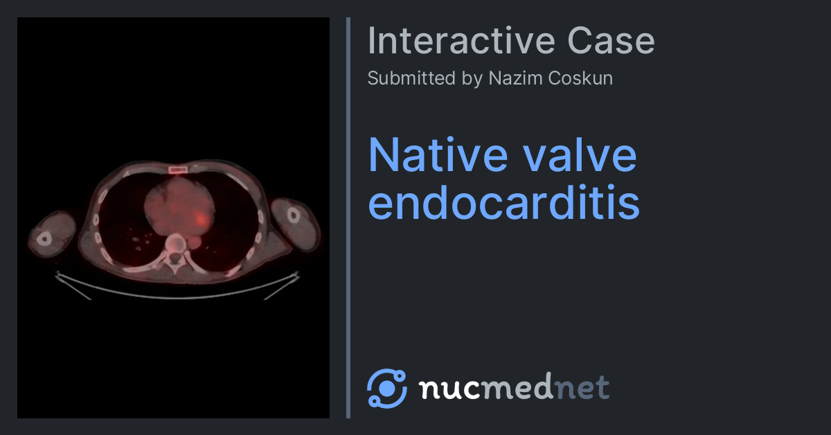 Native valve endocarditis · nucmed.net